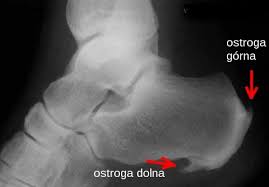 Leczenie ostrogi piętowej Warszawa - wkładki ortopedyczne